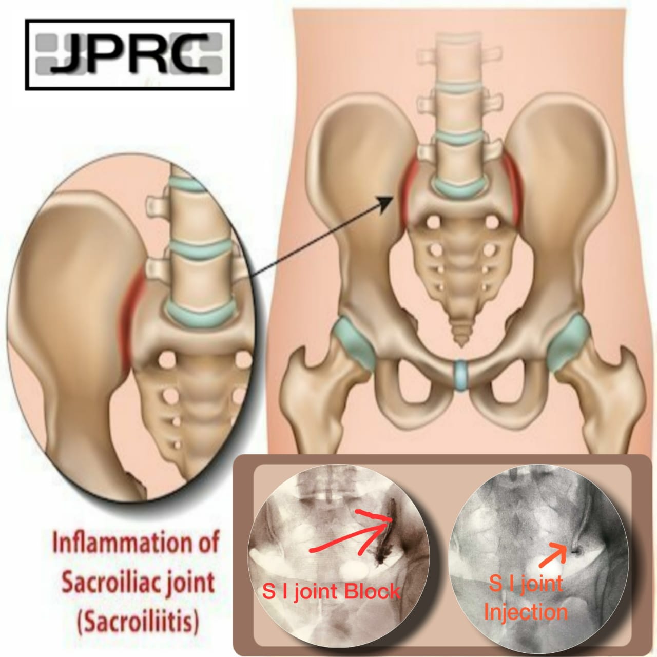 Sacroiliac Dysfunction Sacroiliac Dysfunction